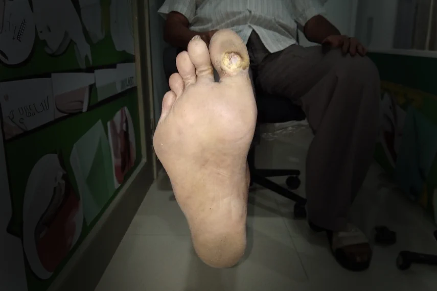 Diabetic Foot And Toe Ulcers Treatment Prevention Causes 9351